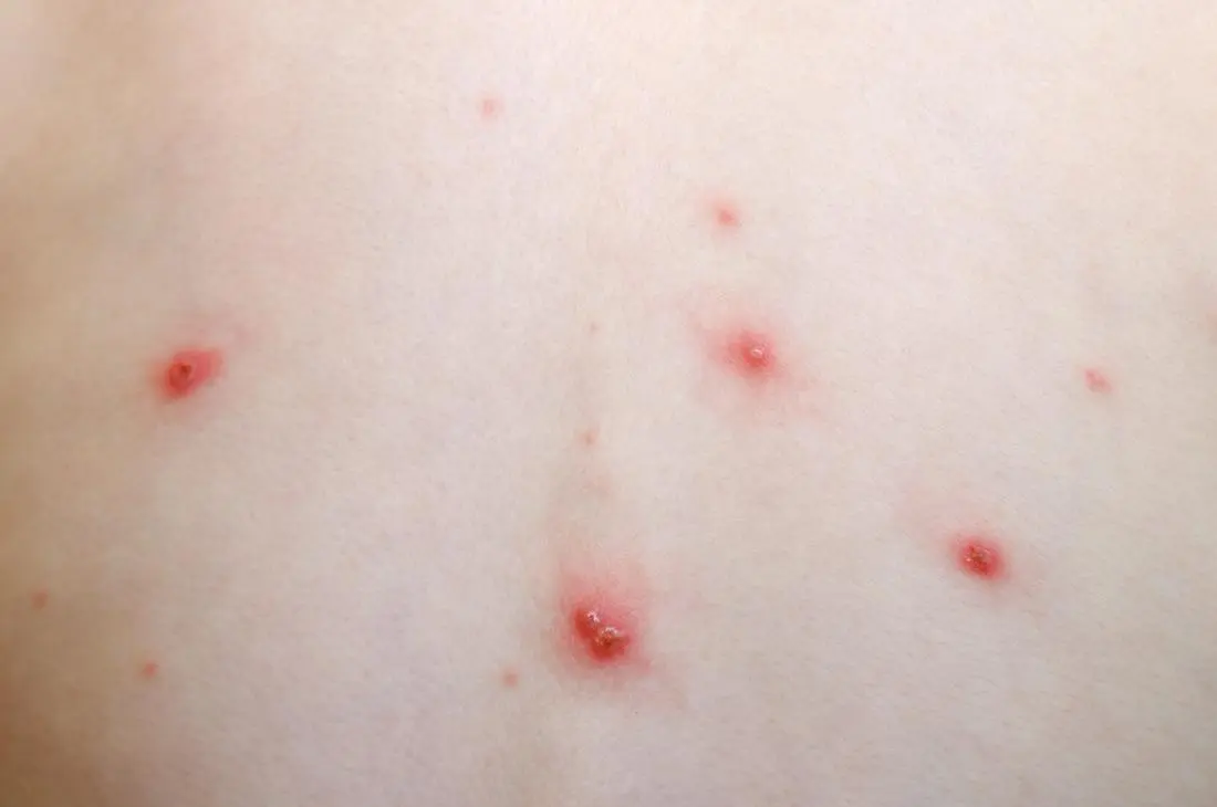 Chicken pox case reported in Kupwara’s Langate - The Legitimate